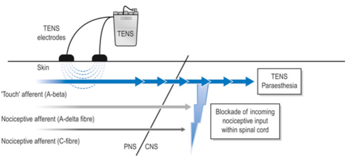TENS vs Transcutaneous Pulsed Radiofrequency: The Secret to Long-Term ...